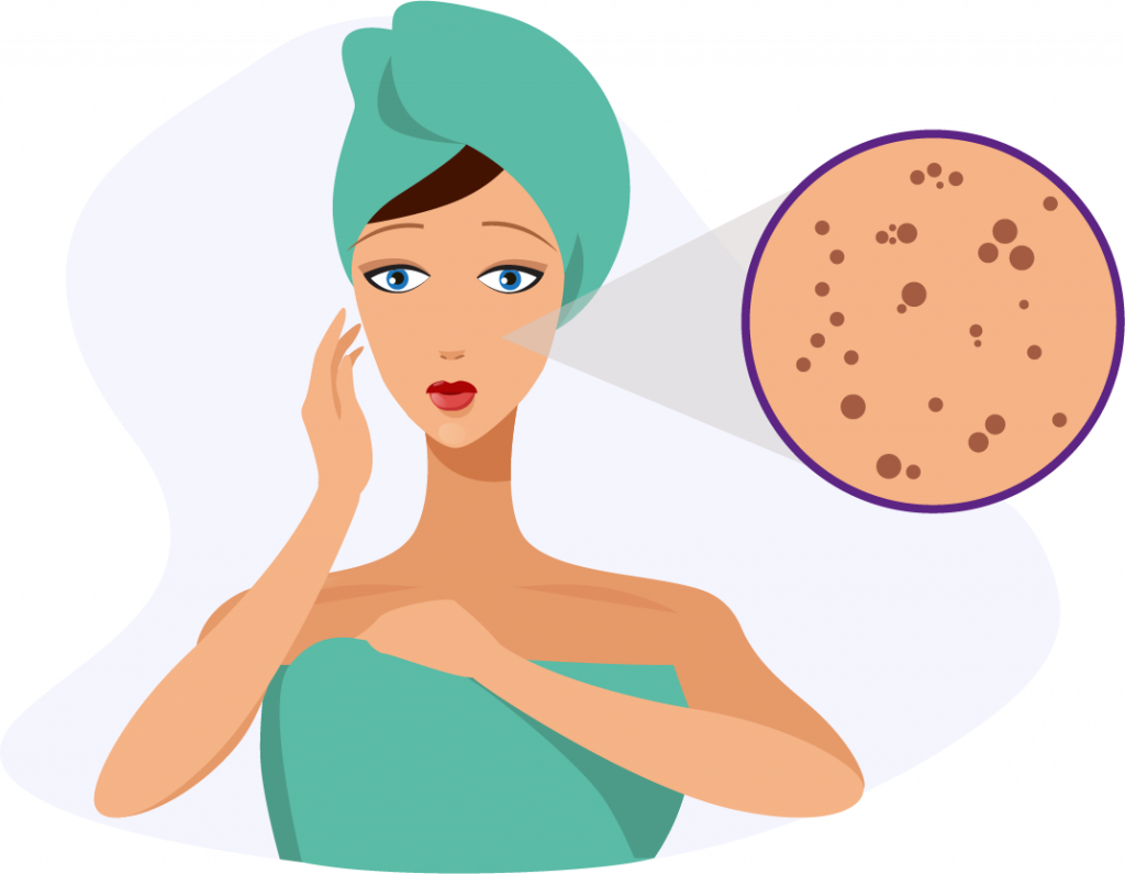 Hyperpigmentation: Causes, Treatment, Prevention & Remedies