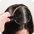 Dandruff: Causes, Symptoms, Home Remedies and Treatment