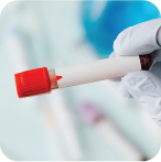 D-Dimer Test: Normal Range, Causes and Elevated Results