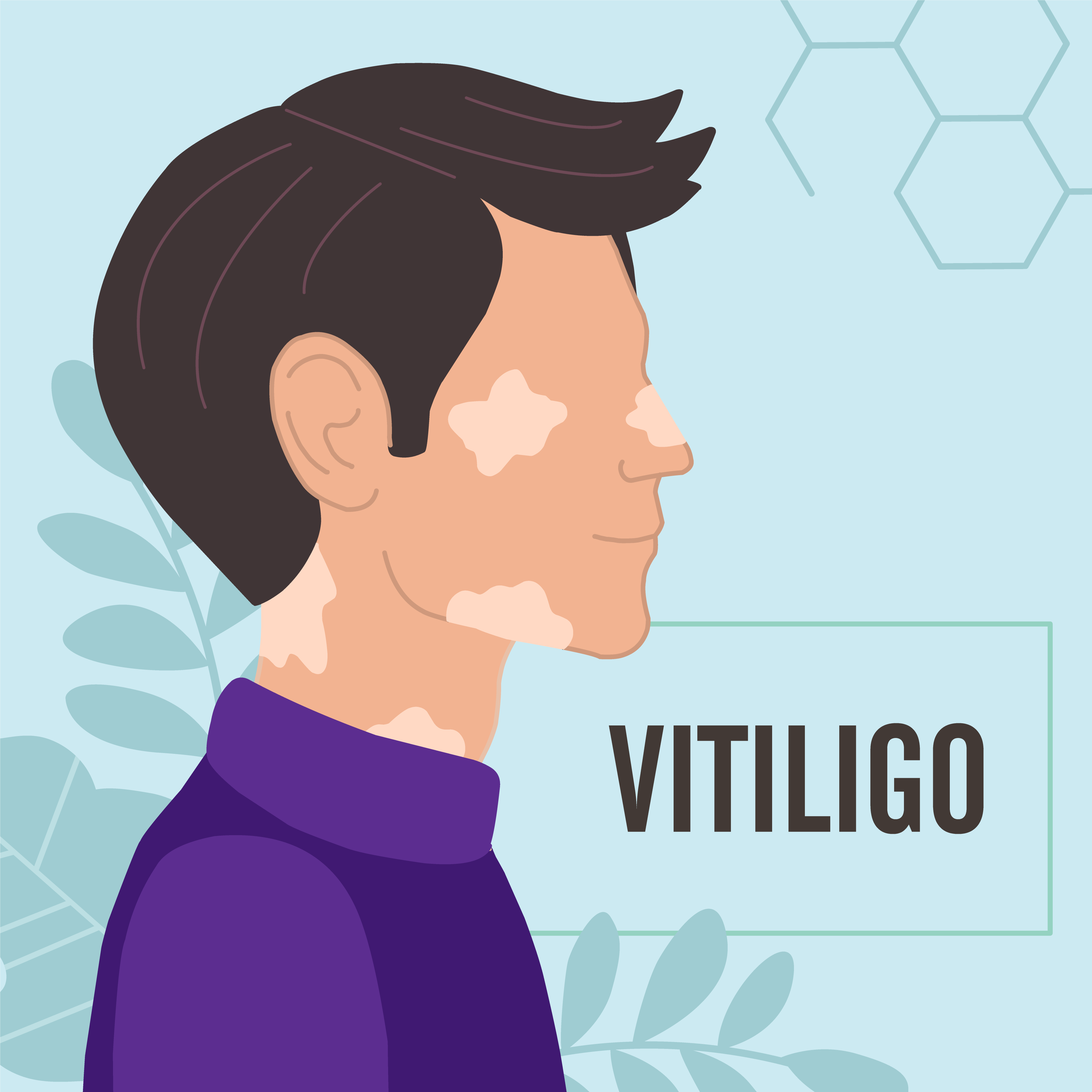 Vitiligo Disease: Treatment, Causes and Home Remedies