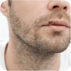 Cold sores Treatment, Causes, symptoms and Diagnosis