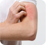 Staph Infection Treatment: 4 Important Things to Know