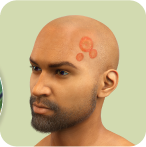 Tinea Capitis: Types, Causes, Symptoms and Prevention