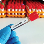 Serum Globulin Test: Types, Purpose, Normal Range & Results