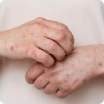 Monsoon Skin Problems: Home Remedies and Prevention Tips