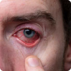 Conjunctivitis (Pink Eyes): Causes, Symptoms and Treatment