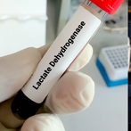 LDH Test: Normal Range, Types, Procedure, and Results