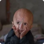Progeria: Causes, Symptoms, Treatment and Diagnosis