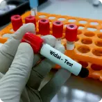 Widal Test Normal Range, Procedure, Purpose, Risk Factor